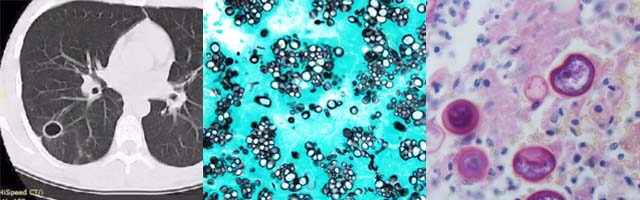 Nikkcosisomycins for Coccidioidomy